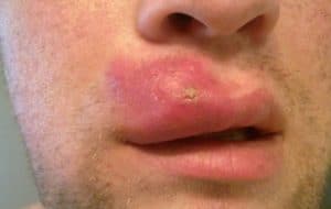 Treating Big, Painful, Infected Lip Pimples Fast - Skincarederm