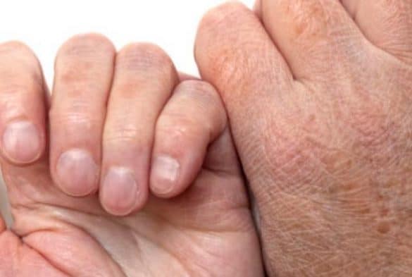 Chapped Skin Causes, Remedies, Dos and Don’ts - Skincarederm