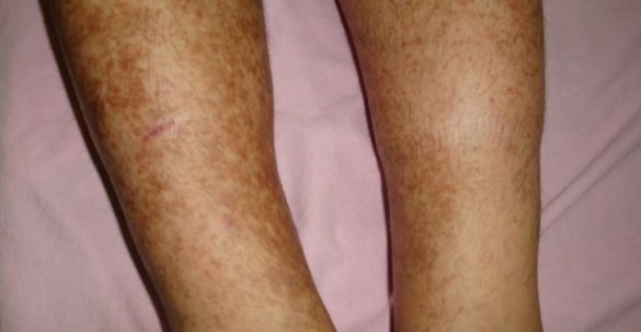 Why Dark Spots on Leg, Bottom of Feet and Cures - Skincarederm