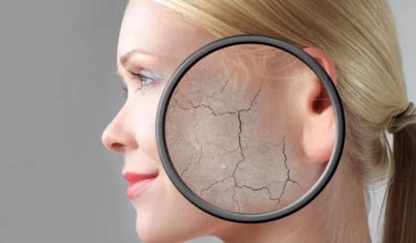 Causes, Symptoms and Treatments of Dehydrated Skin - Skincarederm