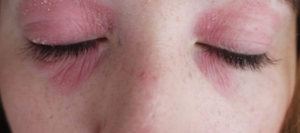 Dry Skin Around Eyes or Eyelids Causes and Treatments - Skincarederm