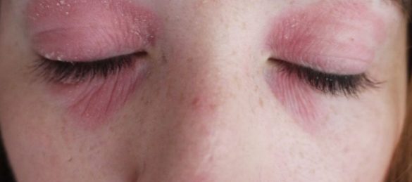 Dry Skin Around Eyes or Eyelids Causes and Treatments - Skincarederm