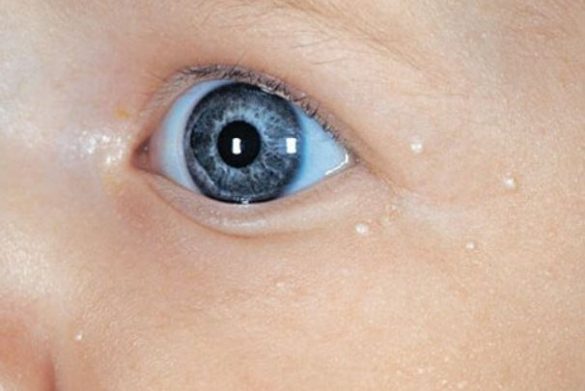 White Spots on Face In Babies and During Pregnancy - Skincarederm