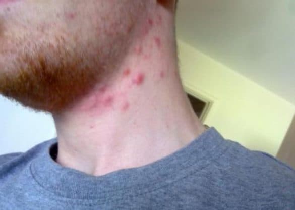 Healing Pimples on Neck Front, Back, Chin and Cheeks - Skincarederm