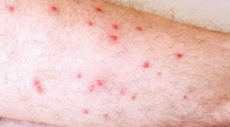 Red Itchy Bumps on Legs Causes and Relief Treatments - Skincarederm