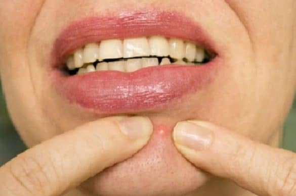 Pimples on Chin: Small, Big, Itchy or Painful Cause - Skincarederm