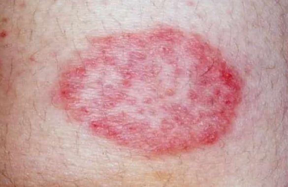 Red Spots on Legs Causes: Small, Raised, Flat or Itchy - Skincarederm