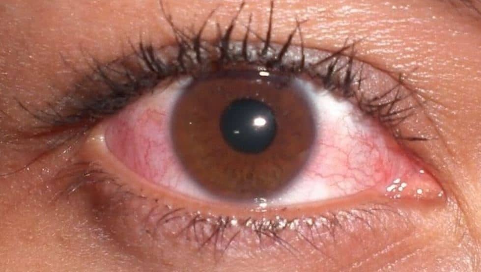Symptoms Of Sunburned Eyes And Fast Relief Ways Skincarederm Symptoms Of Sunburned Eyes And Fast Relief Ways Skincarederm