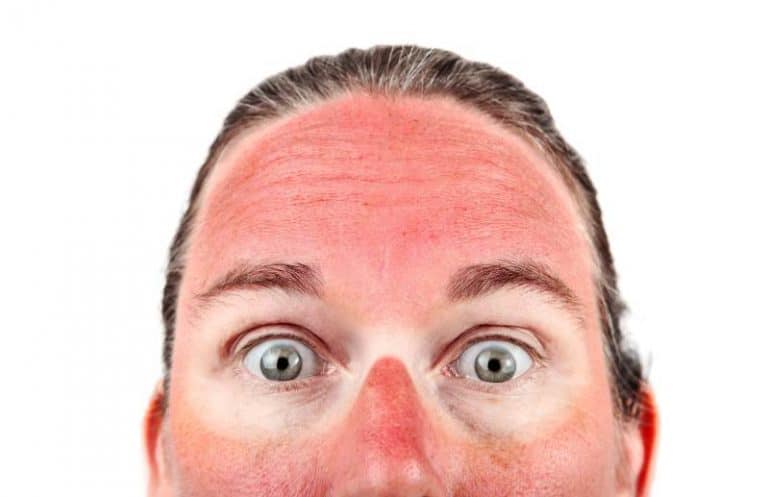 Sunburn Causes, Prevention, Short and Long-term Risks - Skincarederm