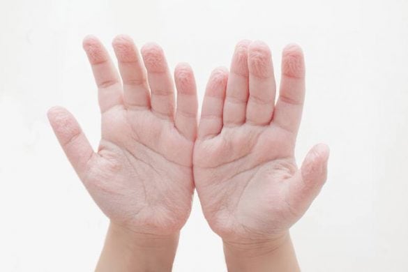 Pruned or Wrinkled Fingers Causes and Treatments - Skincarederm