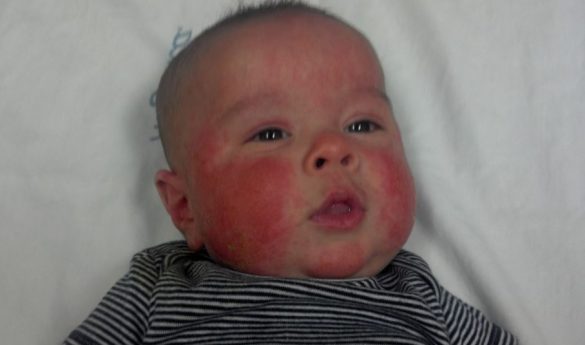 My Baby Has Red Cheeks: Causes, Cures & Remedies - Skincarederm