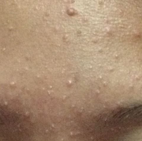 Crusty Belly Button Causes and Treatment Remedies - Skincarederm